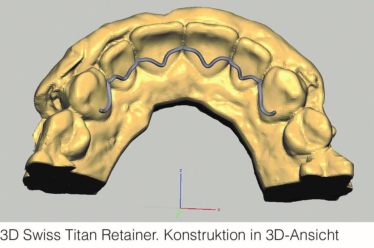 3D Titan Retainer – für beste Passung bei absoluter Biokompatibilität